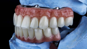 Kivehető fogsor: visszanyert mosoly és életminőség - Dr. Németh Bálint